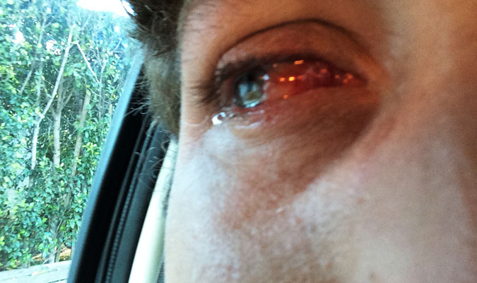 I Got A Pterygium Cut Out of My Eyeball, and I Learned These 20 Things ...