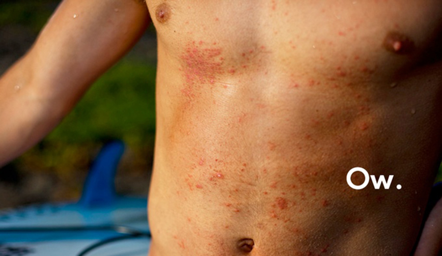 Thank God! Here’s Your Cure for Surf Rash | The Inertia