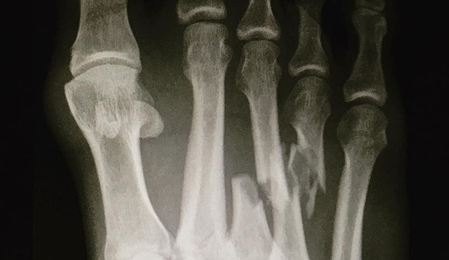 Understanding the Severity of Kelly's Broken Foot (and How Surfers ...