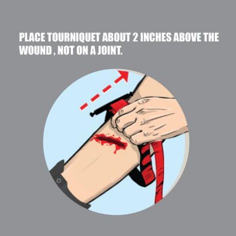 A 7-Point Guide to Properly Applying a Tourniquet for Surfing First Aid ...