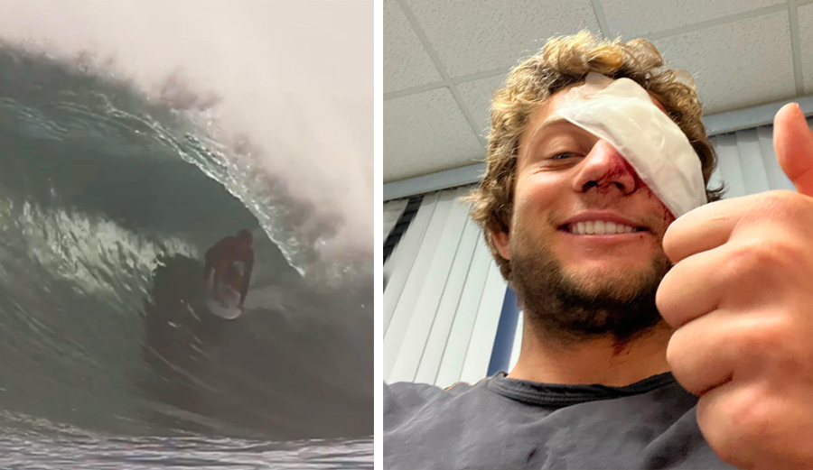 Parker Coffin Suffers Head Injury After Serious Wipeout in Barbados